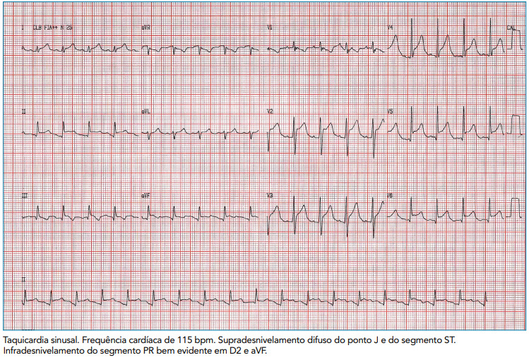 Resumo de pericardite aguda: diagnóstico, tratamento e mais!