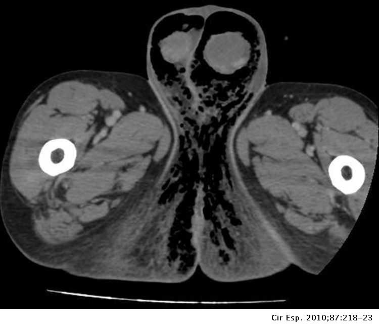Resumo de gangrena de Fournier: diagnóstico, tratamento e mais!
