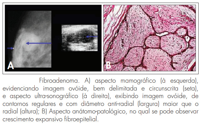 Resumo de nódulos benignos da mama: diagnóstico e mais!