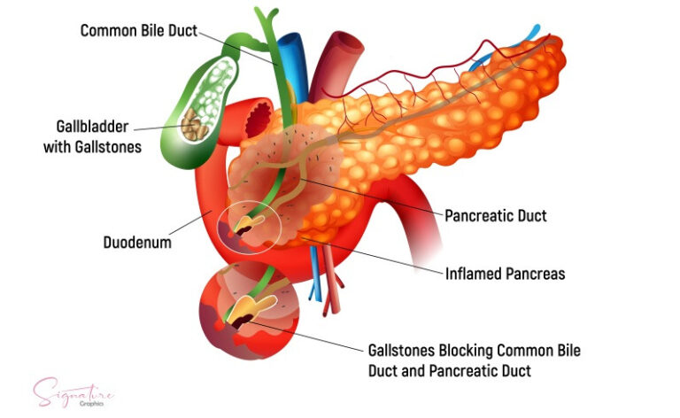 Resumo de complicações da litíase biliar: diagnóstico, tratamento e mais!