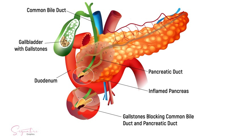 Resumo de complicações da litíase biliar: diagnóstico, tratamento e mais!