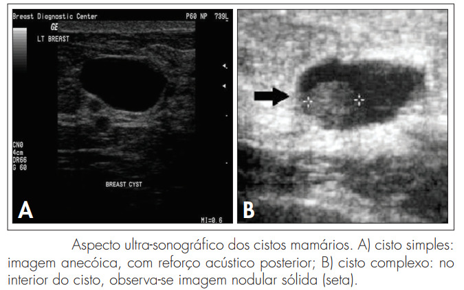 Resumo de nódulos benignos da mama: diagnóstico e mais!