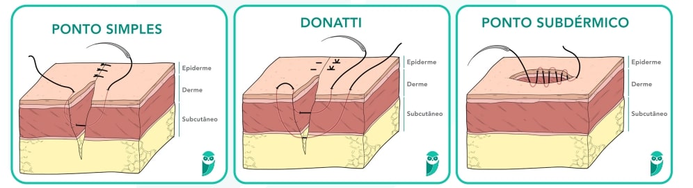 Resumo de Sutura: tipos, indicações e mais!