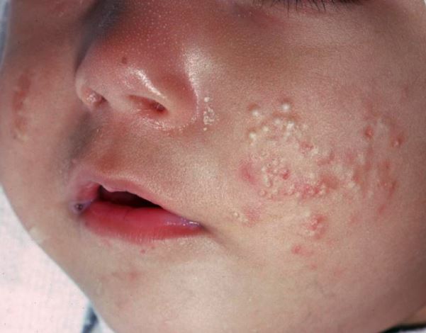 Neonatal Acne Wikipedia