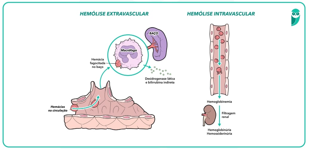 Resumo de Anemia Hemolítica: conceito, classificação e mais!